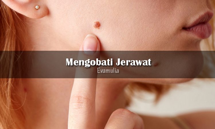 Jerawat - Penyebab Dan Cara Mengatasi | Eva Mulia Clinic