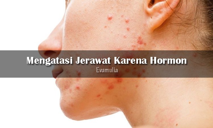 Cara Mengatasi Jerawat Karena Hormon | Eva Mulia Clinic