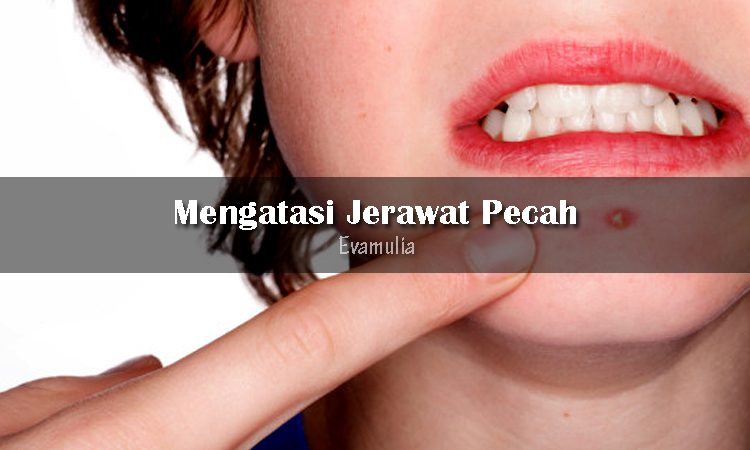 Tips Mengatasi Jerawat Pecah Dengan Mudah | Eva Mulia Clinic