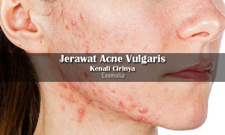 Jerawat Acne Vulgaris dan Pengobatannya | Eva Mulia Clinic