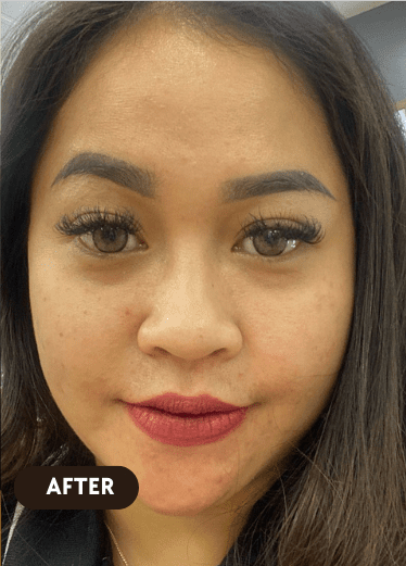 after 1 | Eva Mulia Clinic